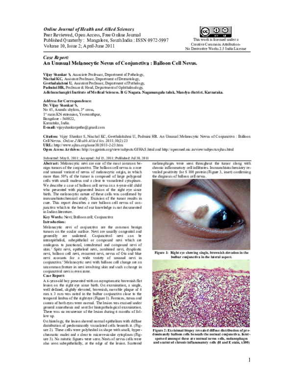 (PDF) An unusual melanocytic nevus of conjunctiva : Balloon cell nevus