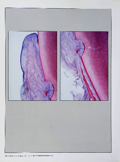 (PDF) Clinical and histologic evaluation of human gingival recession ...