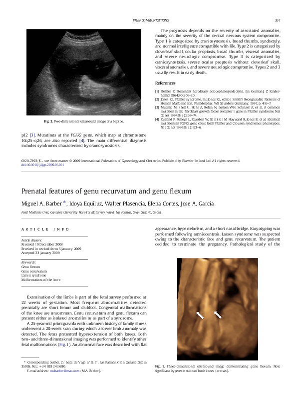 (PDF) Prenatal features of genu recurvatum and genu flexum