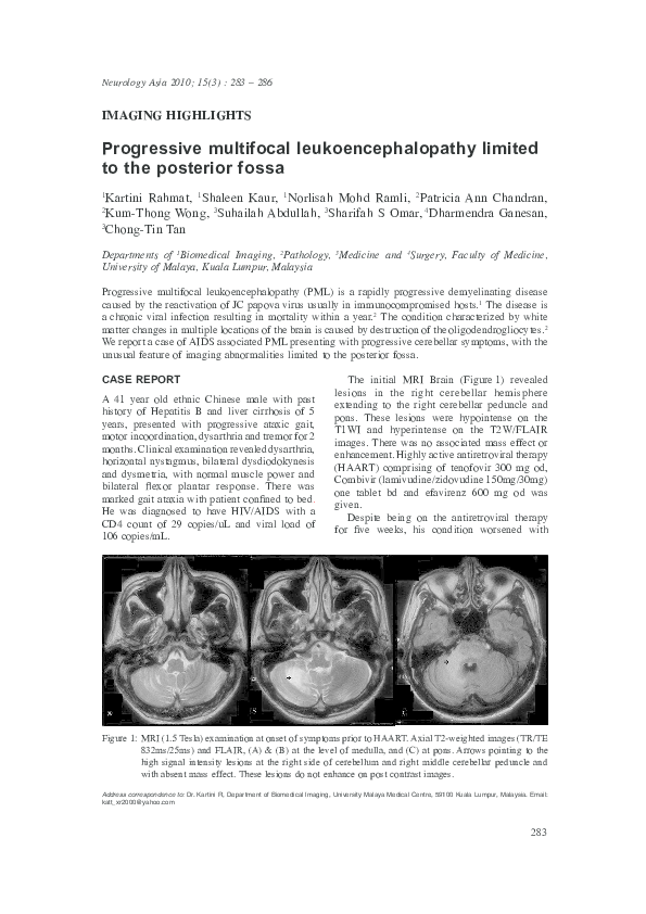 Progressive Multifocal Leukoencephalopathy Histology