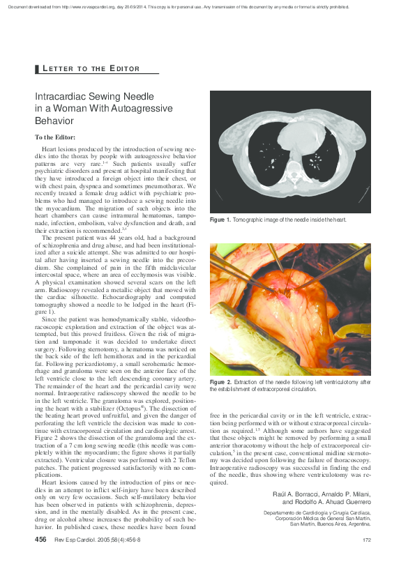 (PDF) Intracardiac Sewing Needle in a Woman With Autoagressive Behavior