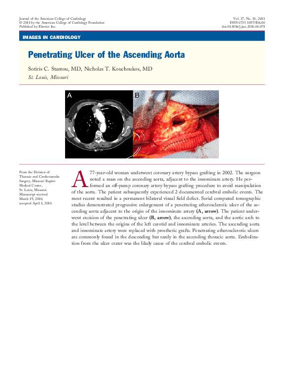 (PDF) Penetrating Ulcer of the Ascending Aorta