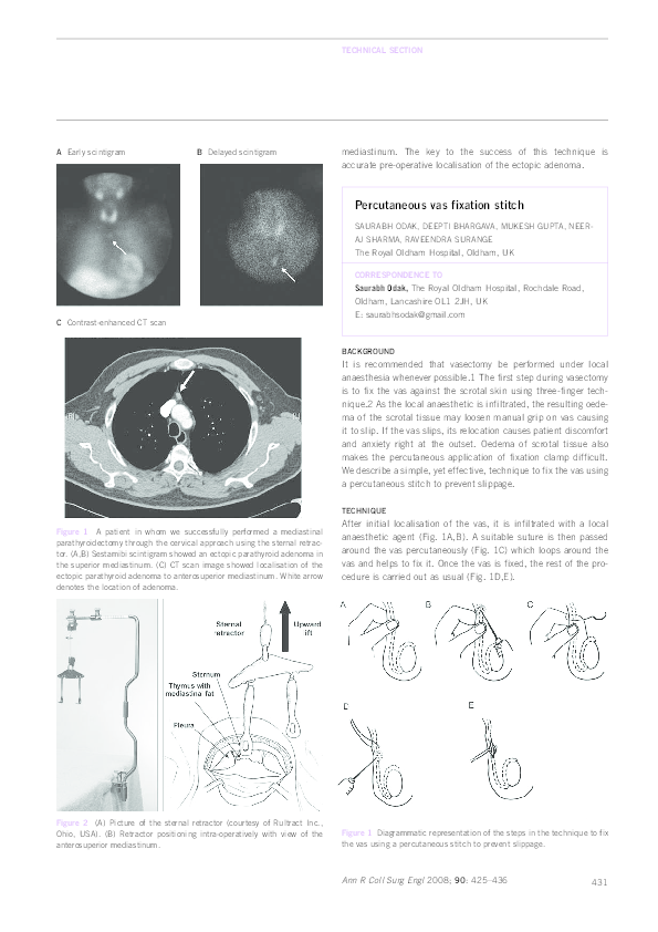 (PDF) Percutaneous vas fixation stitch