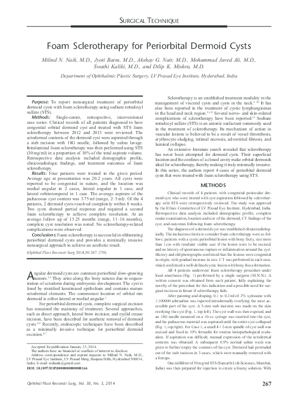 (PDF) Foam Sclerotherapy for Periorbital Dermoid Cysts
