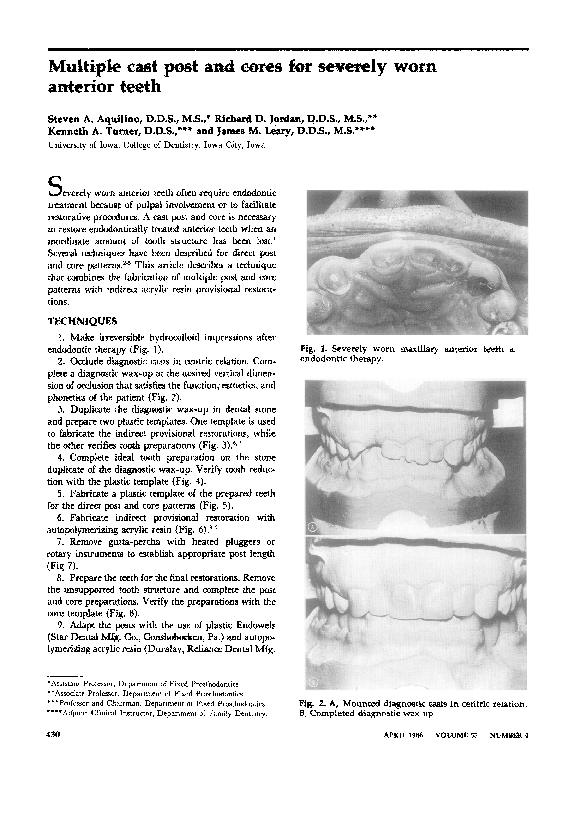 (PDF) Multiple cast post and cores for severely worn anterior teeth