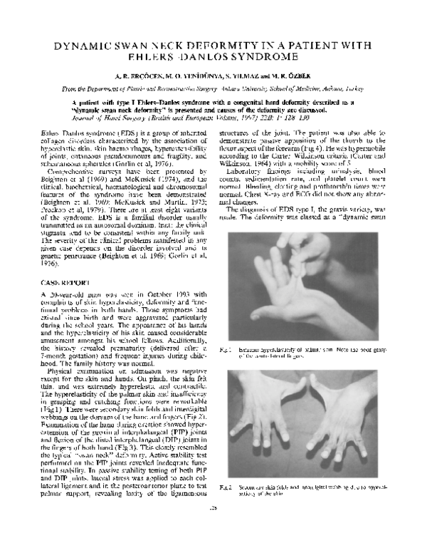 (PDF) Dynamic swan neck deformity in a patient with Ehlers-Danlos syndrome