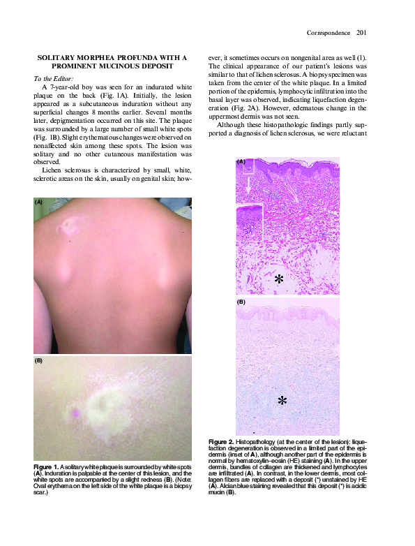 (PDF) Solitary Morphea Profunda with a Prominent Mucinous Deposit