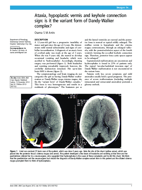 (PDF) Ataxia, hypoplastic vermis and keyhole connection sign: is it the ...