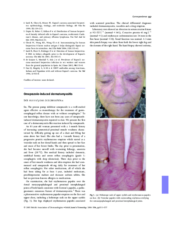 (PDF) Omeprazole-induced dermatomyositis