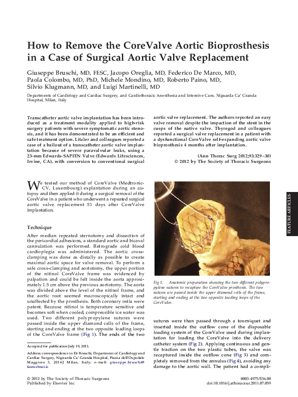 (PDF) How to Remove the CoreValve Aortic Bioprosthesis in a Case of ...