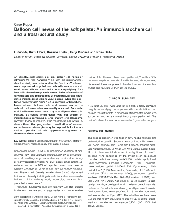 (PDF) Balloon cell nevus of the soft palate: An immunohistochemical and ...
