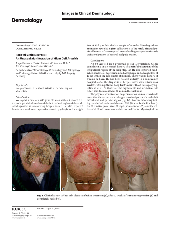 (PDF) Parietal Scalp Necrosis: An Unusual Manifestation of Giant Cell ... (PDF) Parietal Scalp Necrosis: An Unusual Manifestation of Giant Cell ...