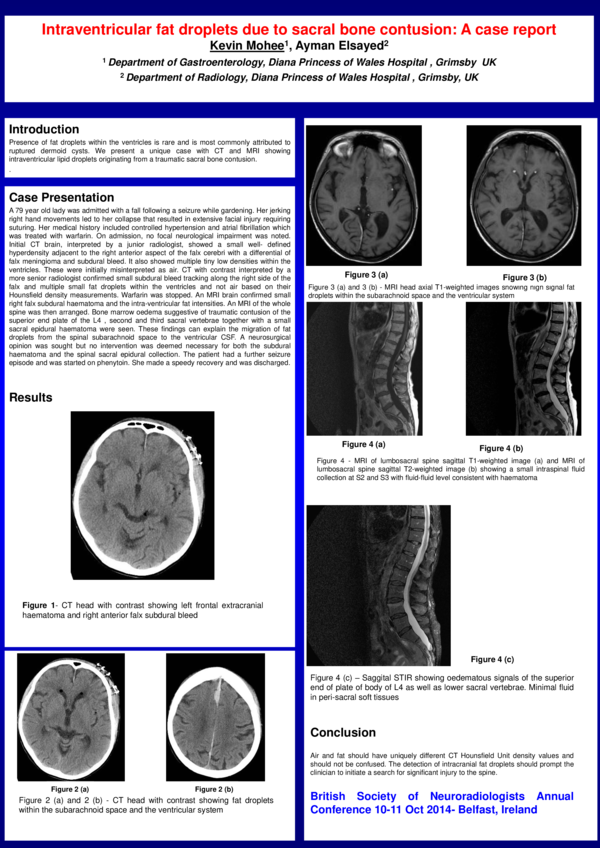(PDF) Intraventricular fat droplets due to sacral bone contusion: A ...