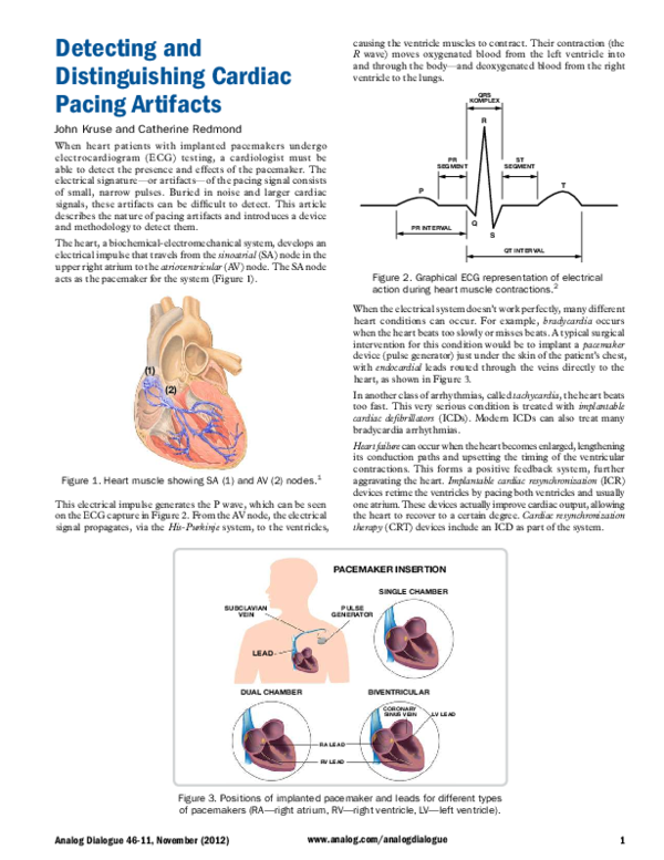 (PDF) Detecting and Distinguishing Cardiac Pacing Artifacts