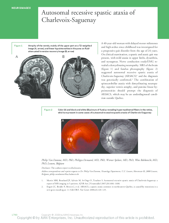 (PDF) Autosomal recessive spastic ataxia of Charlevoix-Saguenay (ARSACS): typical clinical and ...