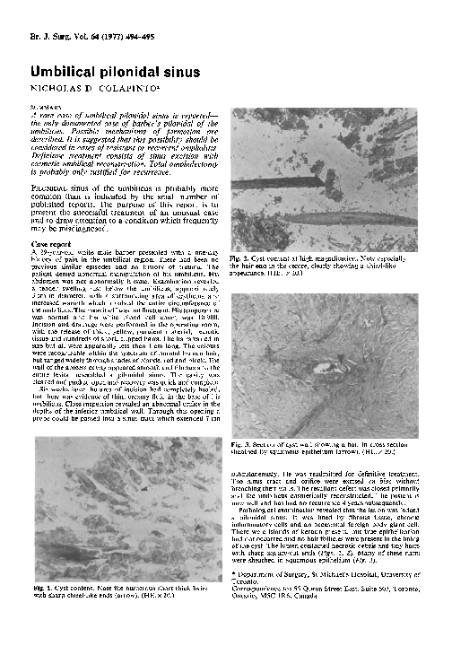 (PDF) Umbilical pilonidal sinus