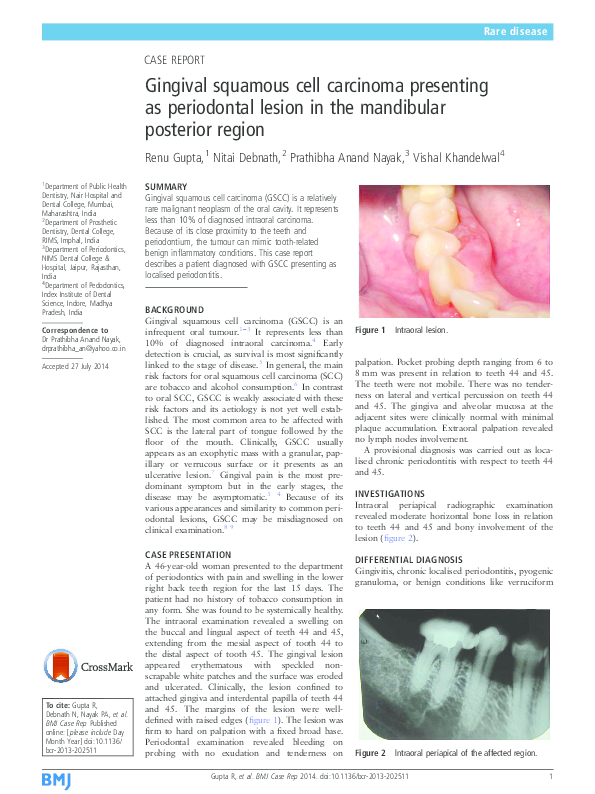 (PDF) Gingival squamous cell carcinoma presenting as periodontal lesion ...