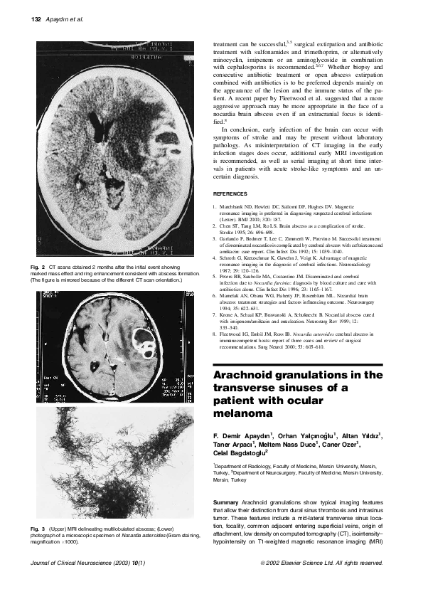 (PDF) Arachnoid granulations in the transverse sinuses of a patient ...