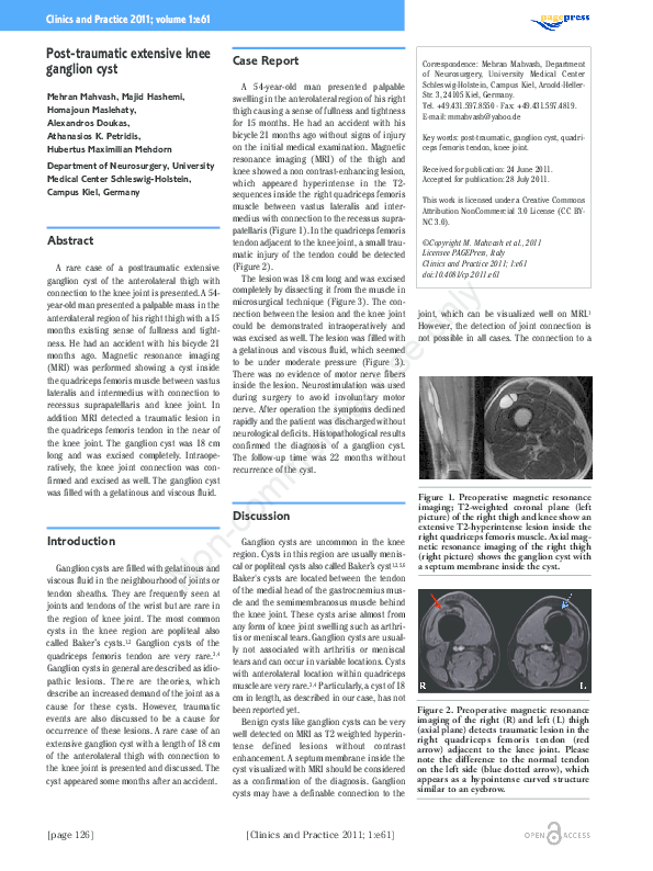 (PDF) Post-traumatic extensive knee ganglion cyst