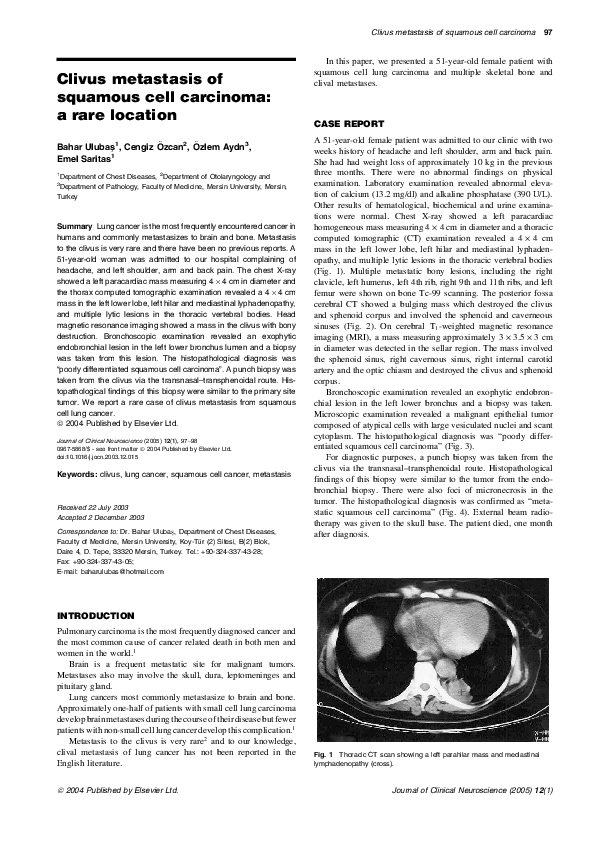 (PDF) Clivus metastasis of squamous cell carcinoma: a rare location