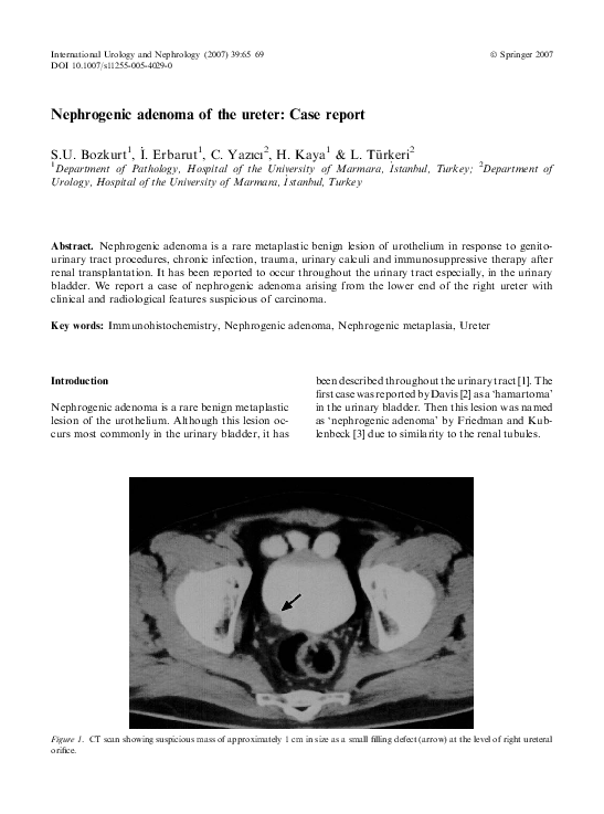 (PDF) Nephrogenic adenoma of the ureter: Case report