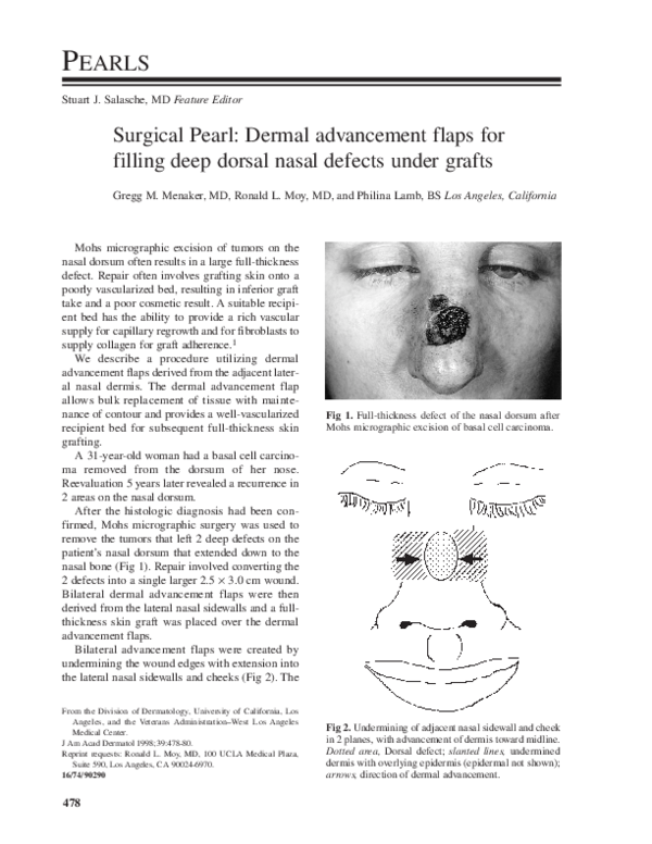 (PDF) Surgical Pearl: Dermal advancement flaps for filling deep dorsal ...