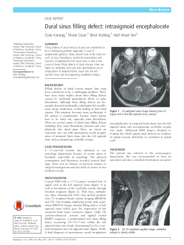 (PDF) Dural sinus filling defect: intrasigmoid encephalocele