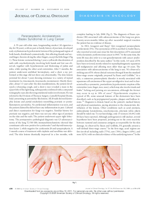 (PDF) Paraneoplastic Acrokeratosis (Bazex Syndrome) in Lung Cancer