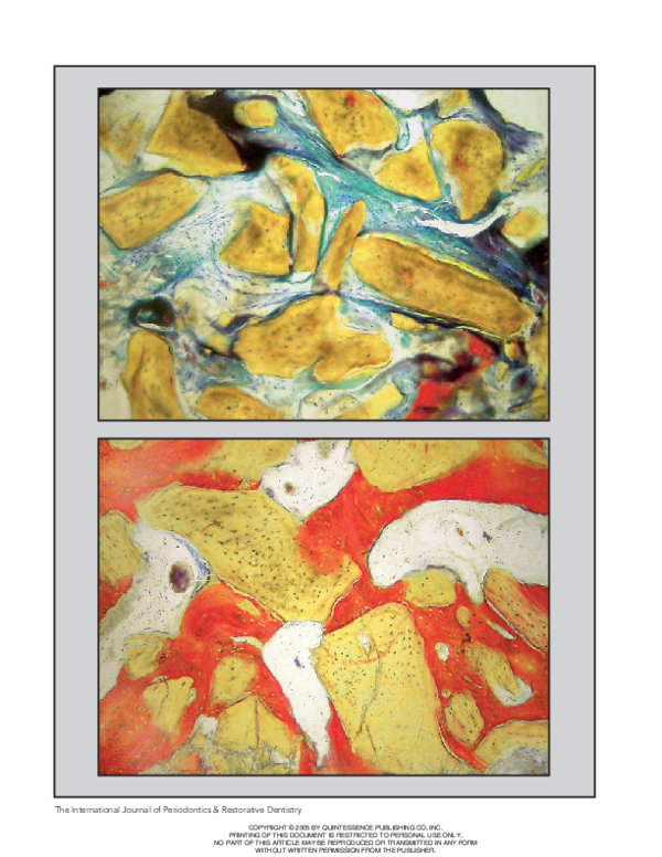 (PDF) Sinus Augmentation Utilizing Anorganic Bovine Bone (Bio-Oss) with ...
