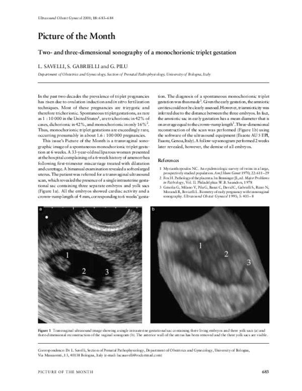 (PDF) Two- and three-dimensional sonography of a monochorionic triplet ...
