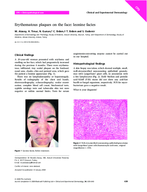 (PDF) Erythematous plaques on the face: leonine facies
