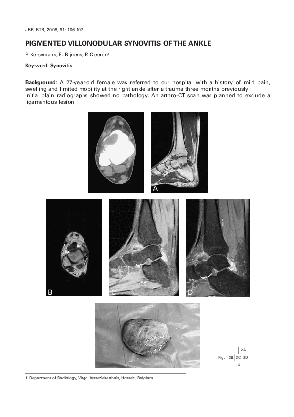 (PDF) Pigmented villonodular synovitis of the ankle
