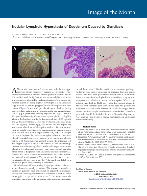 (PDF) Nodular Lymphoid Hyperplasia of Duodenum Caused by Giardiasis