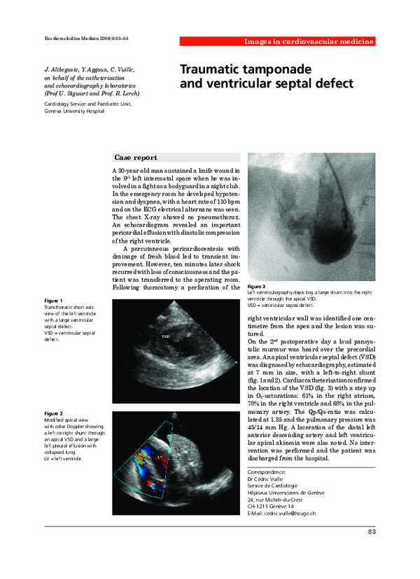 (PDF) Traumatic tamponade and ventricular septal defect
