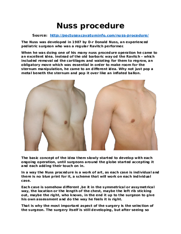 (DOC) Nuss procedure