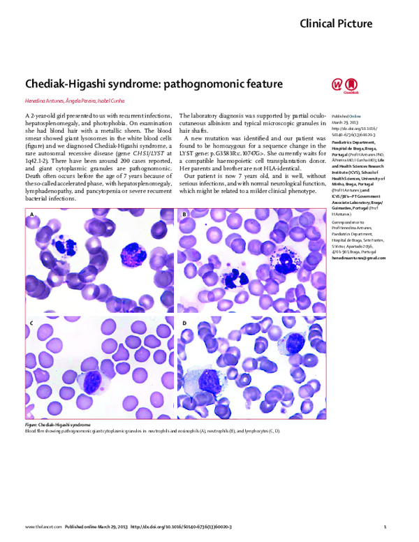 (PDF) Chediak-Higashi syndrome: pathognomonic feature