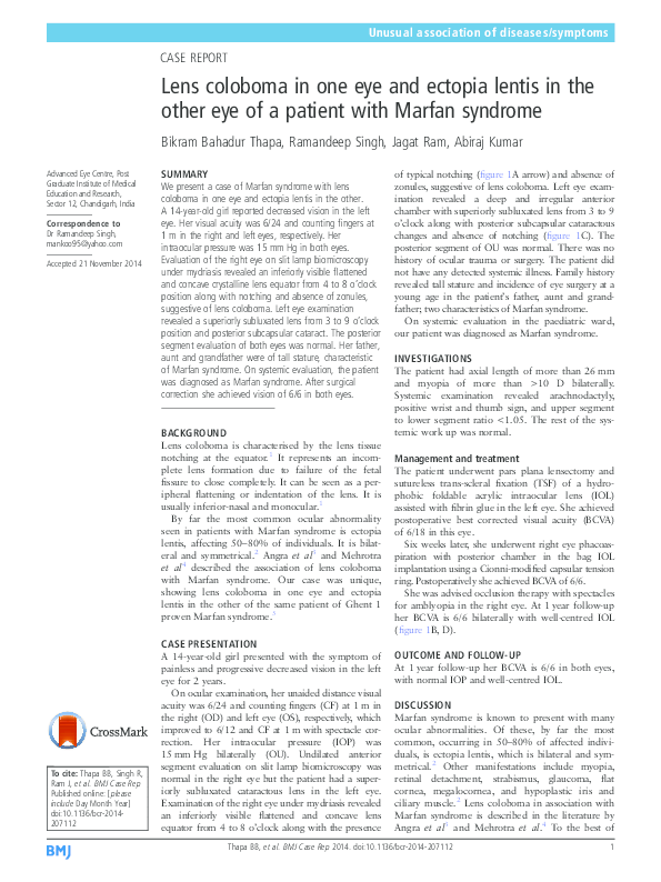 (PDF) Lens coloboma in one eye and ectopia lentis in the other eye of a ...