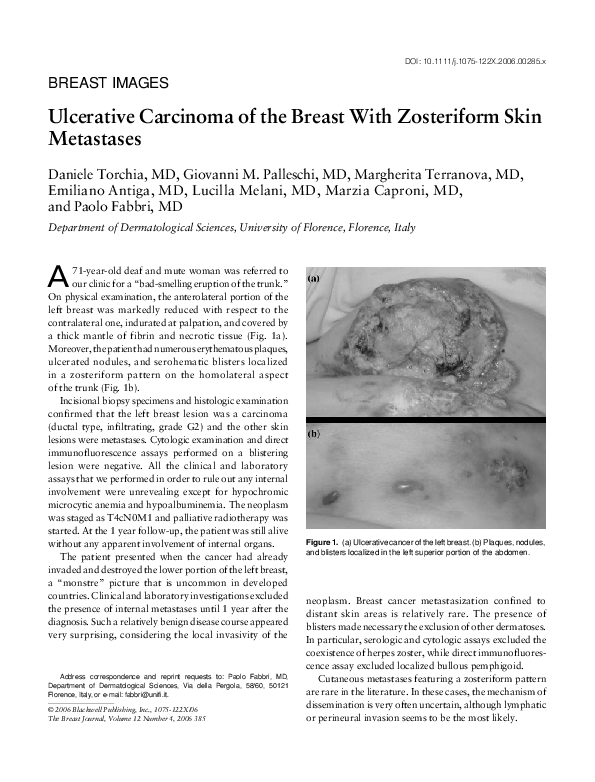 (PDF) Ulcerative Carcinoma of the Breast With Zosteriform Skin Metastases