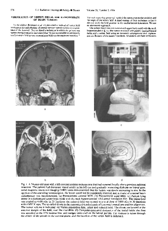 (PDF) Verification of vertex fields for radiotherapy of brain tumors