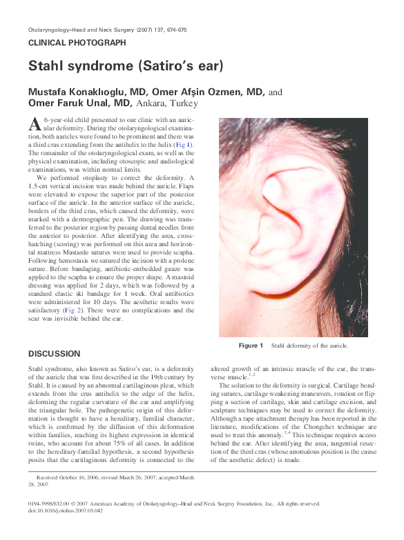 (PDF) Stahl syndrome (Satiro's ear)