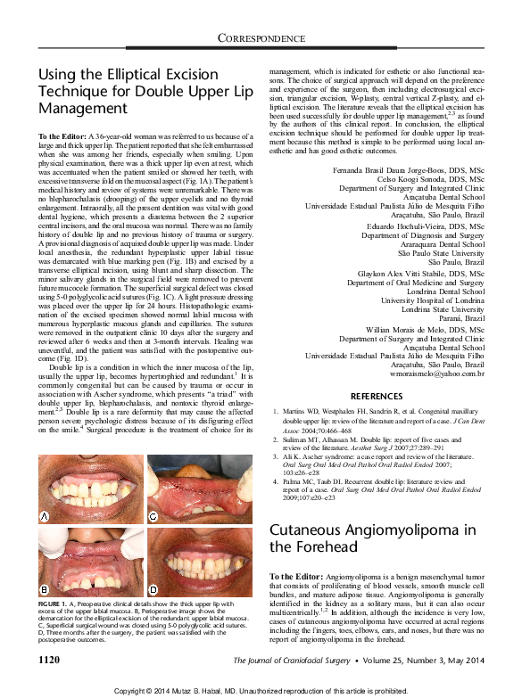 (PDF) Using the Elliptical Excision Technique for Double Upper Lip ...