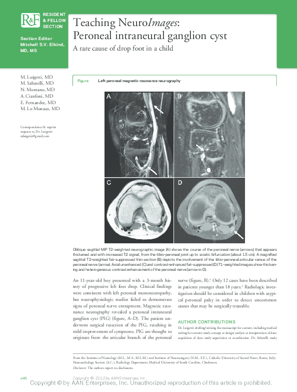 (PDF) Teaching NeuroImages: Peroneal intraneural ganglion cyst: A rare ...