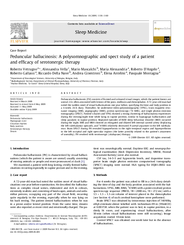 (PDF) Peduncular hallucinosis: A polysomnographic and spect study of a ...