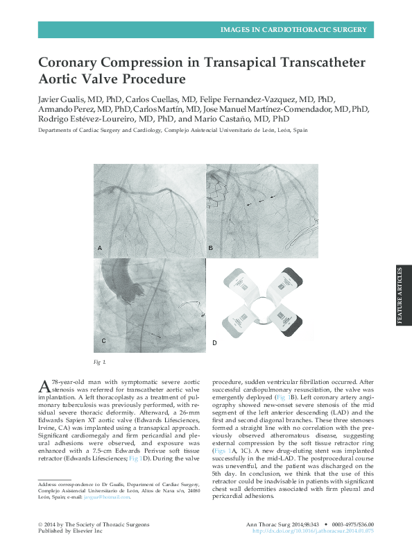 (PDF) Coronary Compression in Transapical Transcatheter Aortic Valve ...