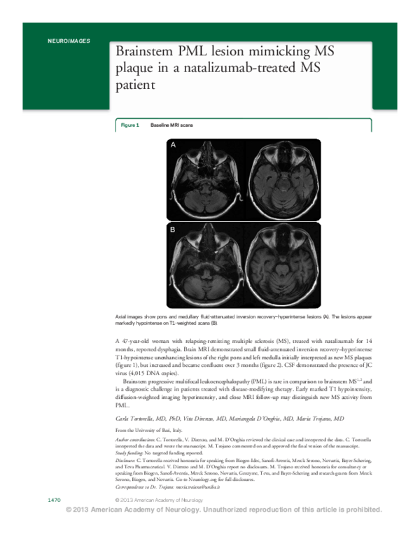 (PDF) Brainstem PML lesion mimicking MS plaque in a natalizumab-treated ...
