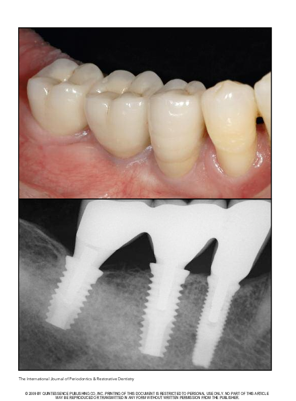 Pdf Evaluation Of Hard Tissue Response Around Wider Platform Switched Implants