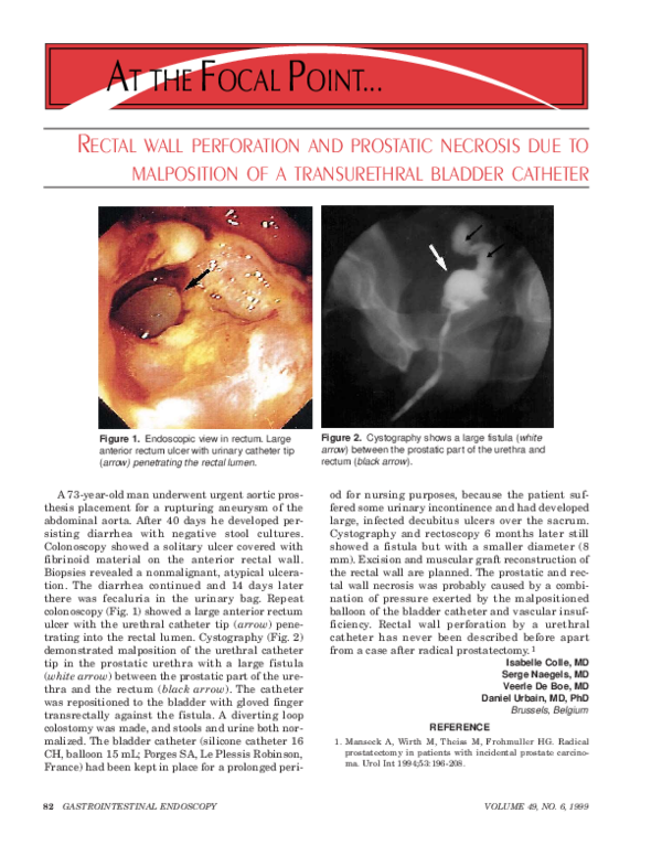 (PDF) Rectal wall perforation and prostatic necrosis due to malposition ...