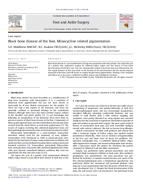 (PDF) Black bone disease of the foot. Minocycline related pigmentation ...