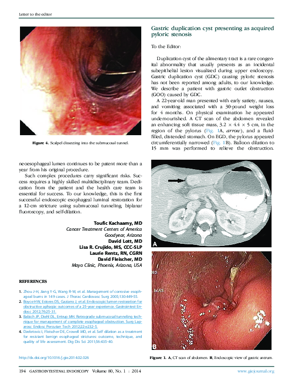 (PDF) Gastric duplication cyst presenting as acquired pyloric stenosis