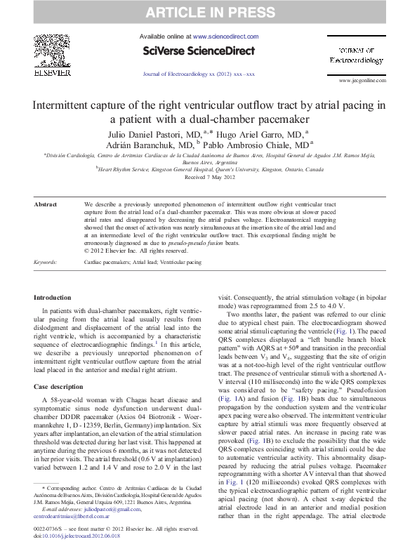 (PDF) Intermittent capture of the right ventricular outflow tract by ...